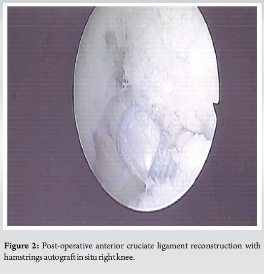Bilateral Anterior Cruciate Ligament Reconstruction with All-Inside ...