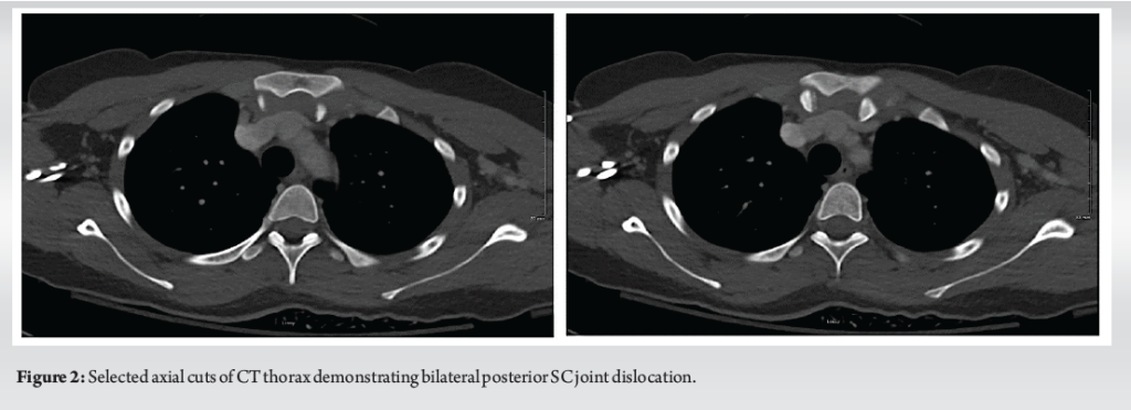 Management of Bilateral Posterior Sternoclavicular Joint Dislocation: A ...
