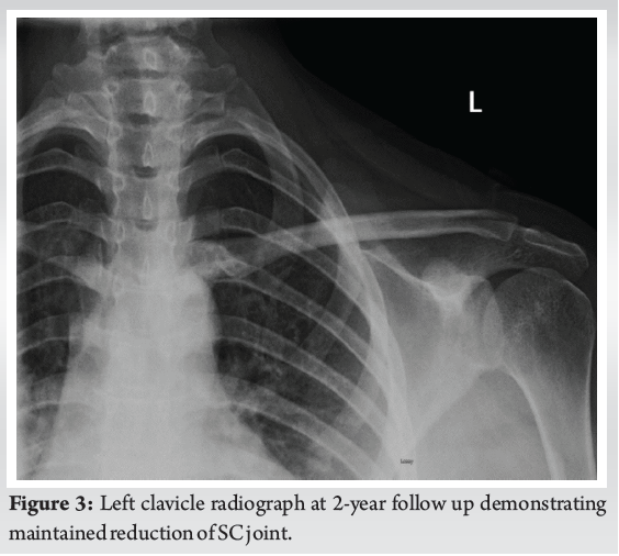 Management of Bilateral Posterior Sternoclavicular Joint Dislocation: A ...