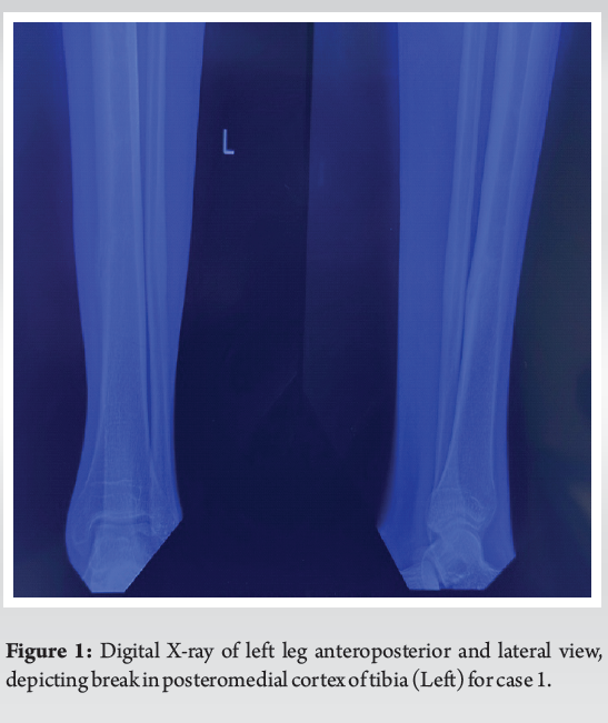 Return to Sports in Stress Reaction and Stress Fractures in Indian ...