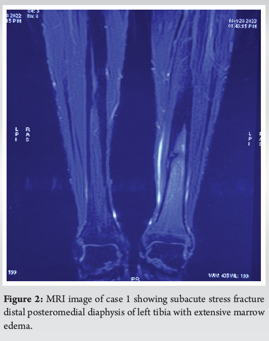 Return to Sports in Stress Reaction and Stress Fractures in Indian ...