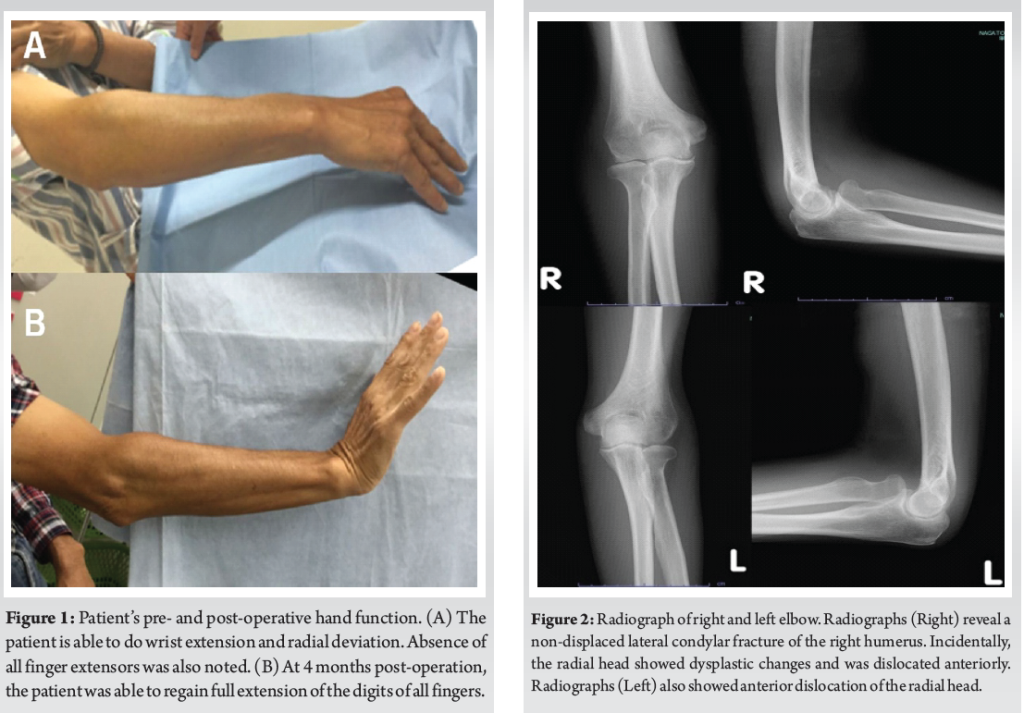 Anterior Congenital Radial Head Dislocation in an Adult with Associated ...