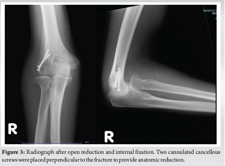 Anterior Congenital Radial Head Dislocation in an Adult with Associated ...