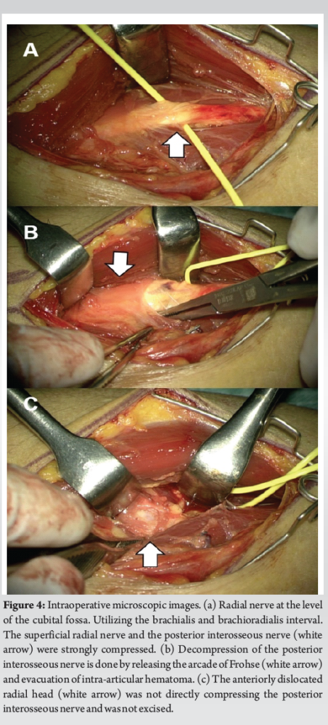 Anterior Congenital Radial Head Dislocation in an Adult with Associated ...