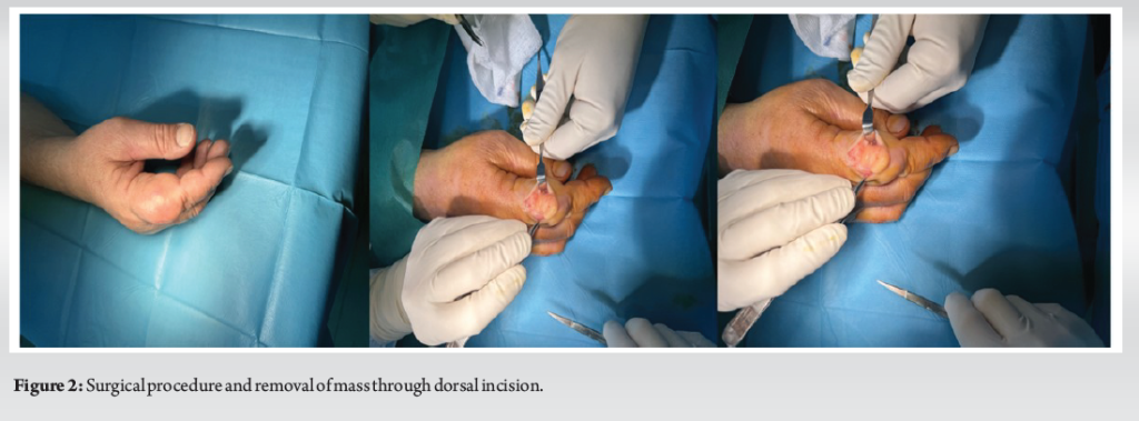 Giant Lipoma in the Index Finger of a 60-Year-Old Patient: A Rare Case ...