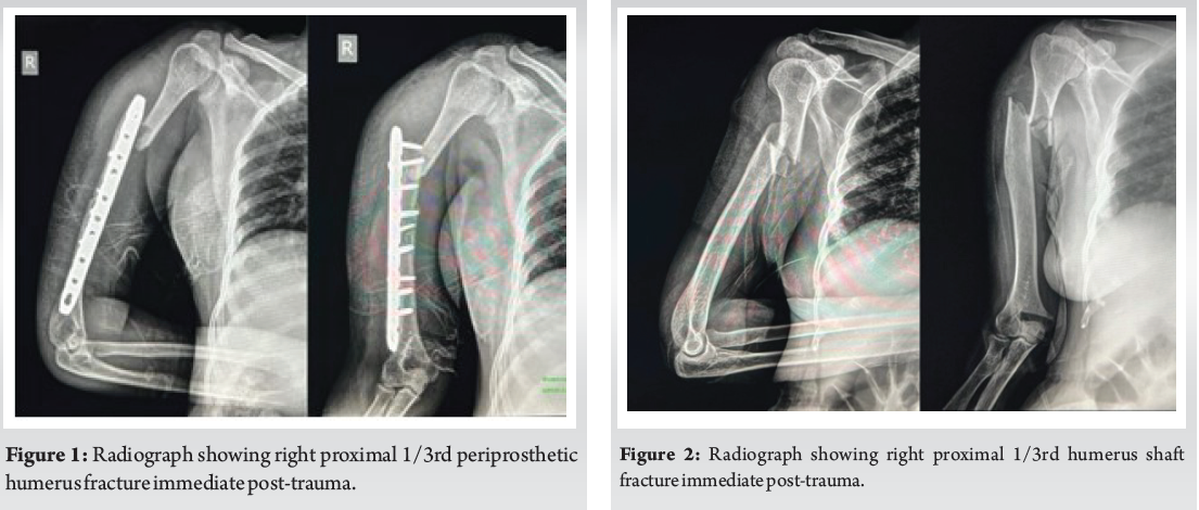 Uncommon Effect of Phenytoin on Fracture Union: Report of Two Cases ...