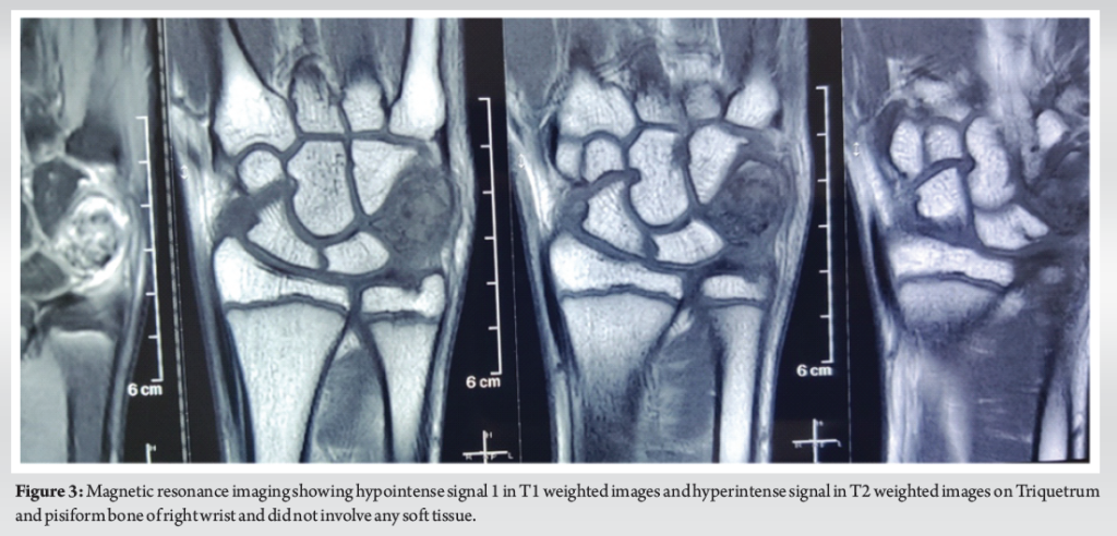 A Rare Case Report of Enchondroma of Triquetrum and Pisiform | Journal ...