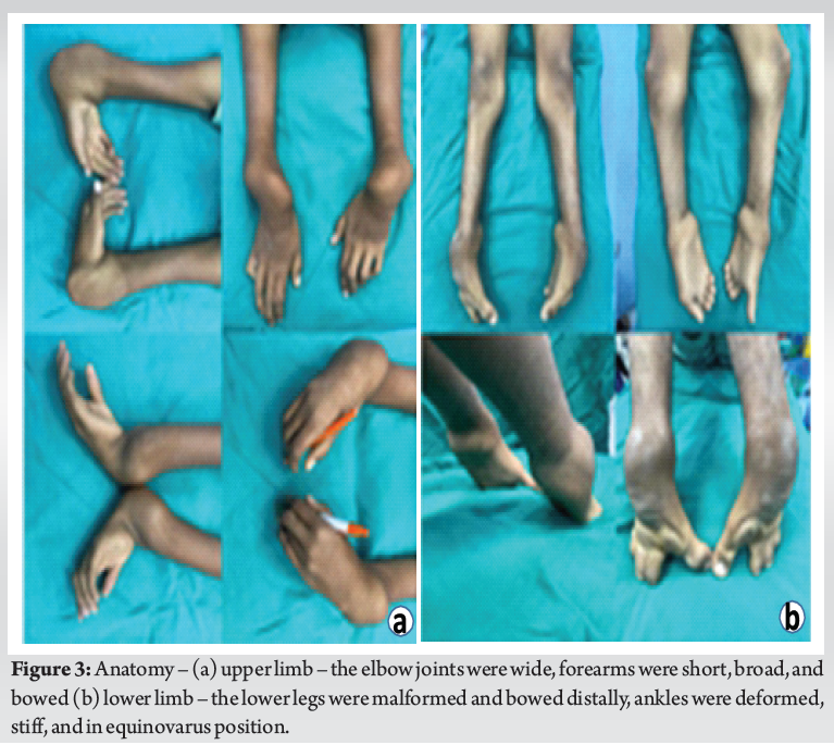 Neglected Bilateral Clubfoot Clubhand Deformity | Journal of ...