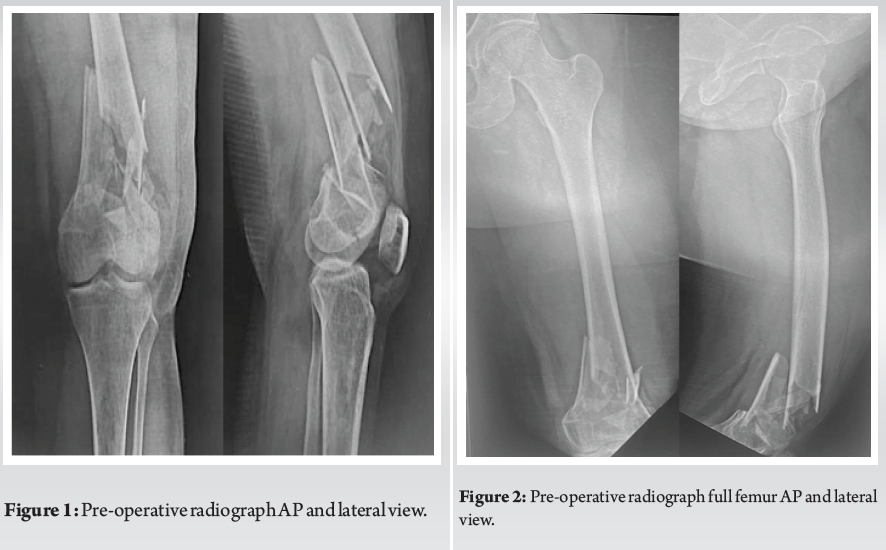 Integrated Nail and Plate Fixation with Allograft in the Management of ...