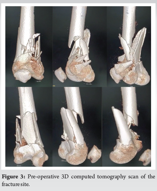 Integrated Nail and Plate Fixation with Allograft in the Management of ...