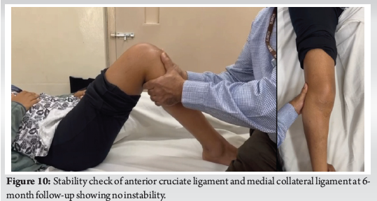 Simultaneous ACL Reconstruction and MCL Reconstruction in Patients with ...