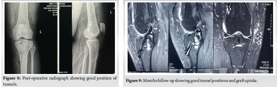 Simultaneous ACL Reconstruction and MCL Reconstruction in Patients with ...