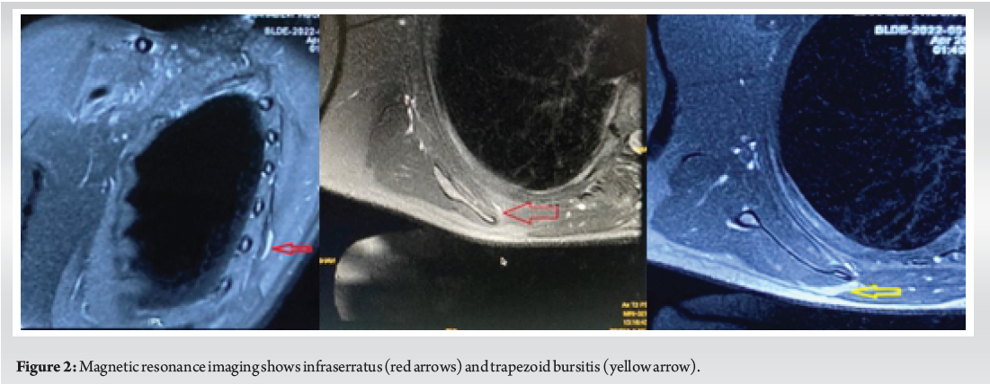 Arthroscopic Management of Snapping Scapular Syndrome due to ...