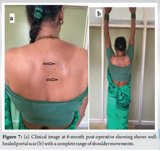 Arthroscopic Management of Snapping Scapular Syndrome due to ...