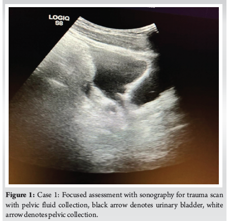 Limitations of Focused Assessment with Sonography for Trauma in Pelvic ...