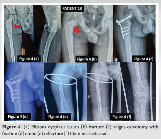 Analysis of Series of Cases of Fibrous Dysplasia of Proximal Femur in ...