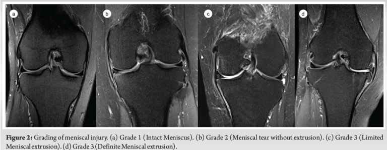 Correlation of Detachment of Proximal Tibia Superficial Medial ...