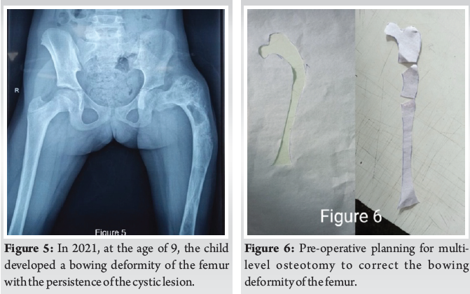 Longitudinal Management of Progressive Femoral Deformities in a ...