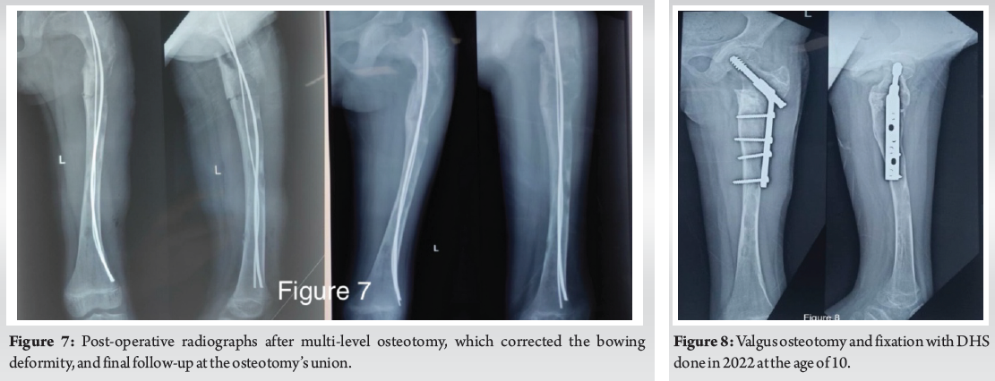 Longitudinal Management of Progressive Femoral Deformities in a ...