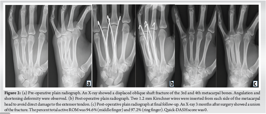 Clinical Outcomes of Retrograde Percutaneous Pinning for Shaft Fracture ...