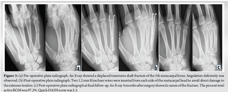 Clinical Outcomes of Retrograde Percutaneous Pinning for Shaft Fracture ...