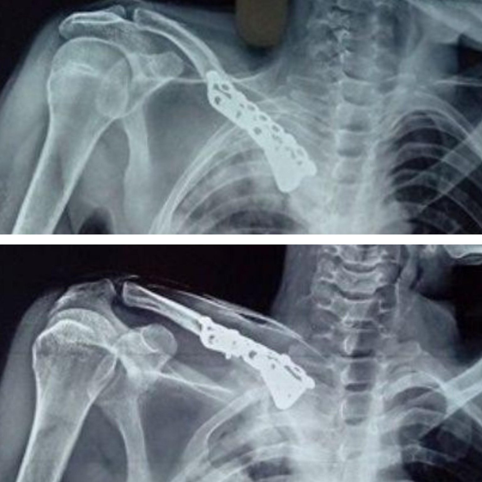 Surgical Treatment of a Non-union of Medial End Clavicle Fracture with ...