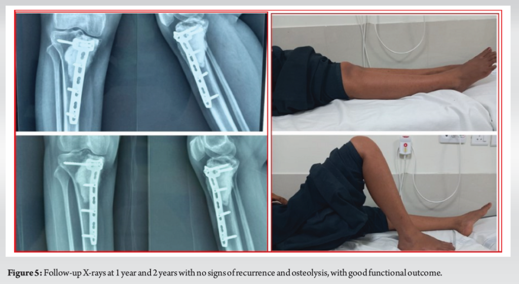 Rare Coexistence: Giant Cell Tumor Recurrence and Infection in the ...