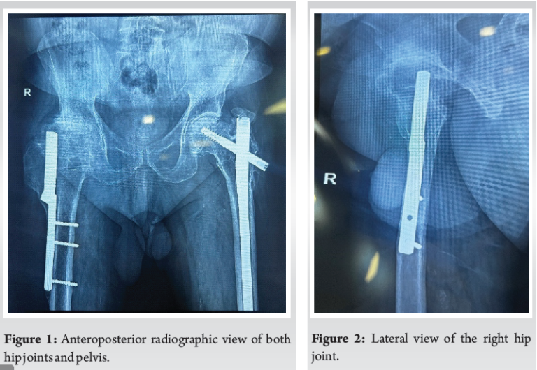 Reverse Sleeve Placement in Complex Total Hip Arthroplasty for a ...