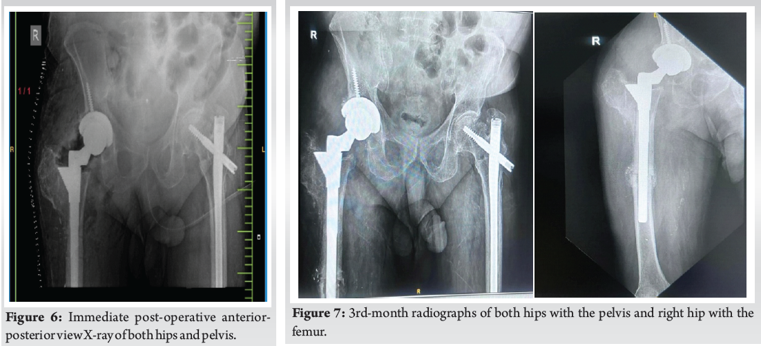 Reverse Sleeve Placement in Complex Total Hip Arthroplasty for a ...