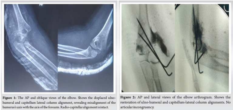 Transphyseal Separation of Distal Humerus Extending to the Lateral ...