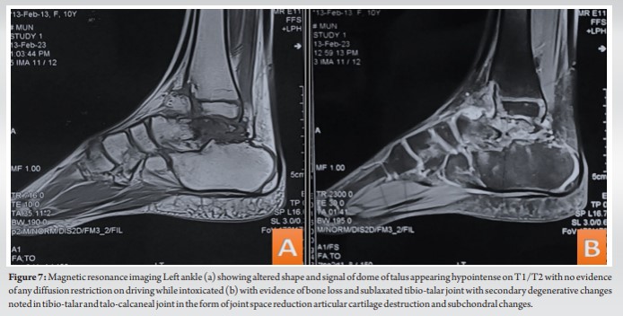 Gunshot Injury to Distal Tibial Physis and Talus: A Case Report ...