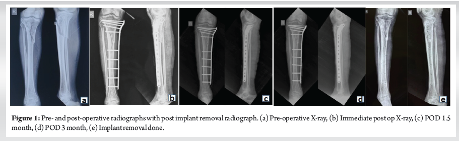 Low Profile, High Impact: External Fixation using Locking Plates in ...