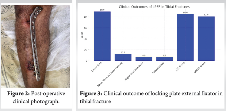 Low Profile, High Impact: External Fixation using Locking Plates in ...