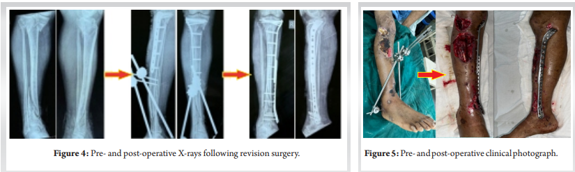 Low Profile, High Impact: External Fixation using Locking Plates in ...