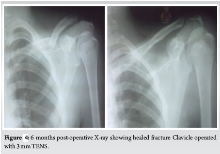 Outcome of Clavicle Fractures Treated by Various Modalities | Journal ...