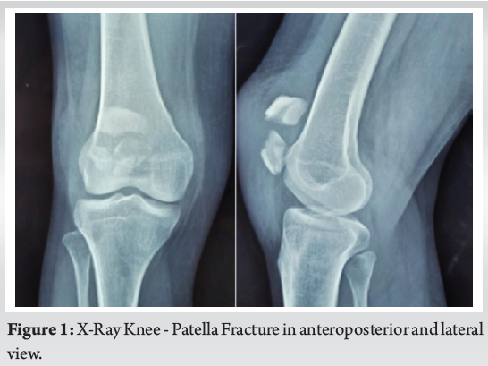 Revisiting Tension Band Principle Using Fiber Tape in Patella Fractures ...