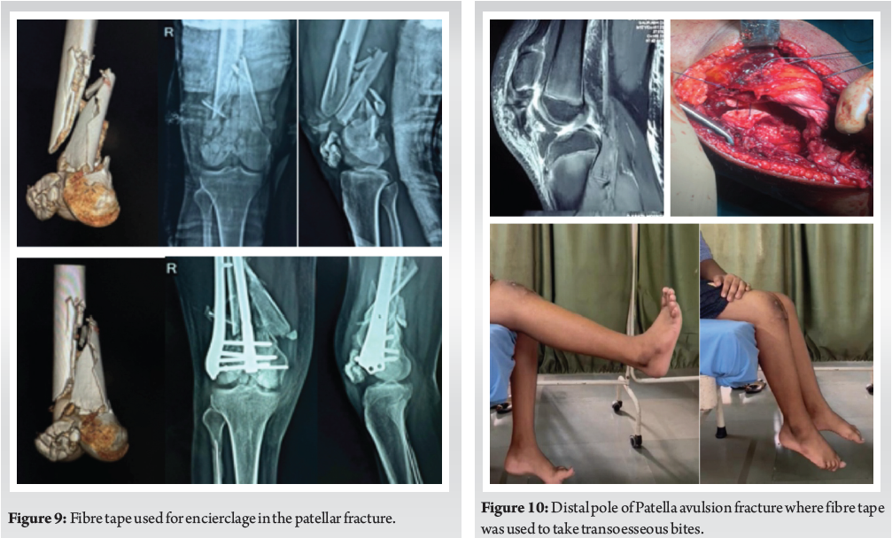 Revisiting Tension Band Principle Using Fiber Tape in Patella Fractures ...