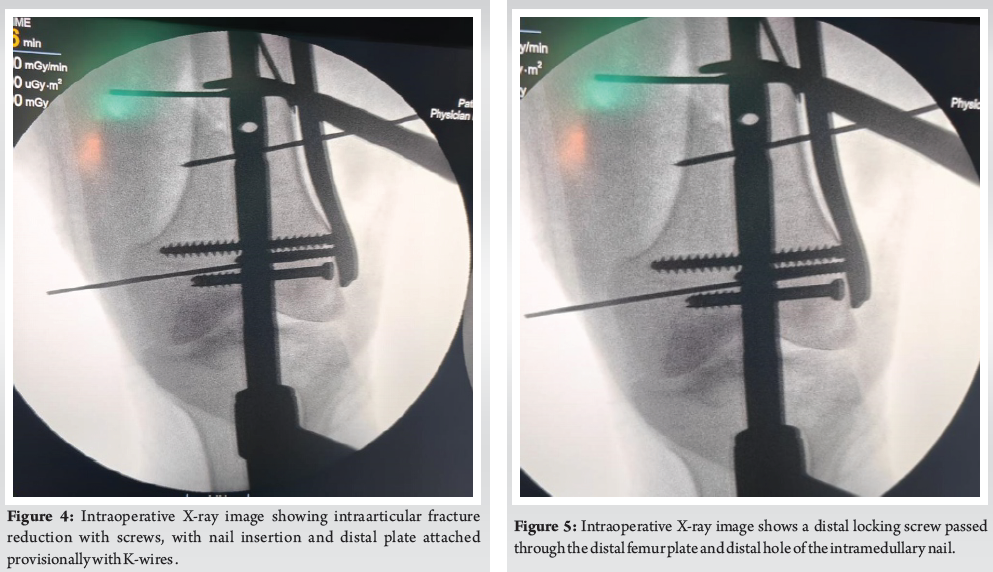 Outcomes of Combined Distal Femur Plating and Retrograde Femur Nailing ...