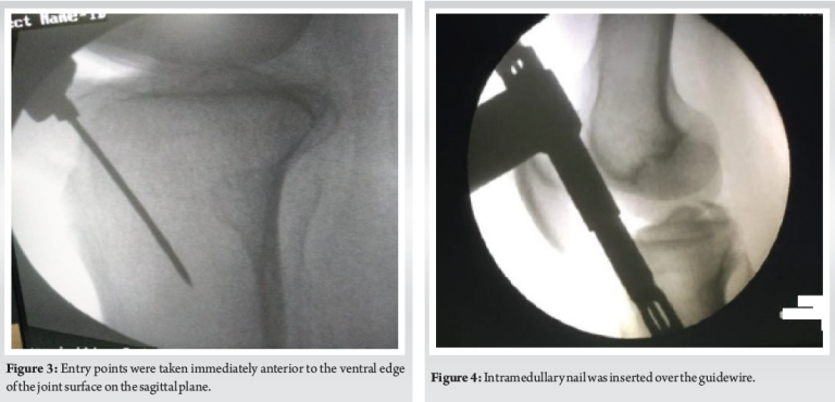 Suprapatellar Technique for Tibia Fractures: Is the Fracture Level ...