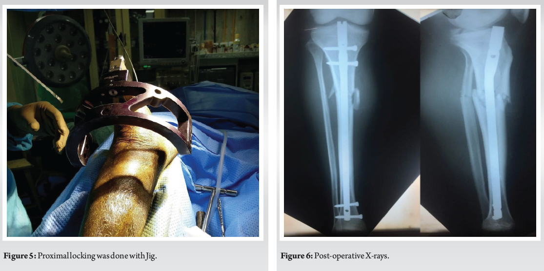 Suprapatellar Technique for Tibia Fractures: Is the Fracture Level ...
