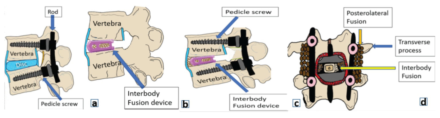 Fixation, Stabilization, Dynamic Stabilization, Fusion, and ...
