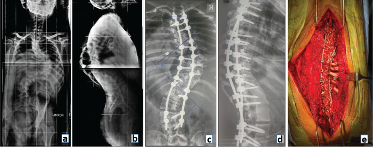 Fixation, Stabilization, Dynamic Stabilization, Fusion, and ...