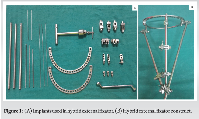 Hybrid External Fixation as A Comprehensive, Safe, and Effective ...