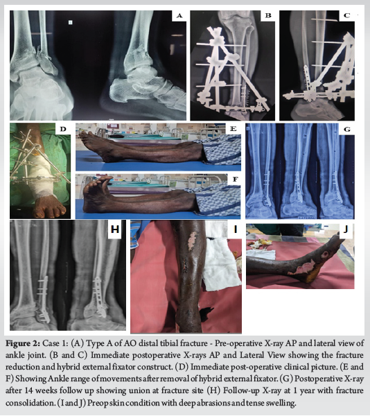 Hybrid External Fixation as A Comprehensive, Safe, and Effective ...