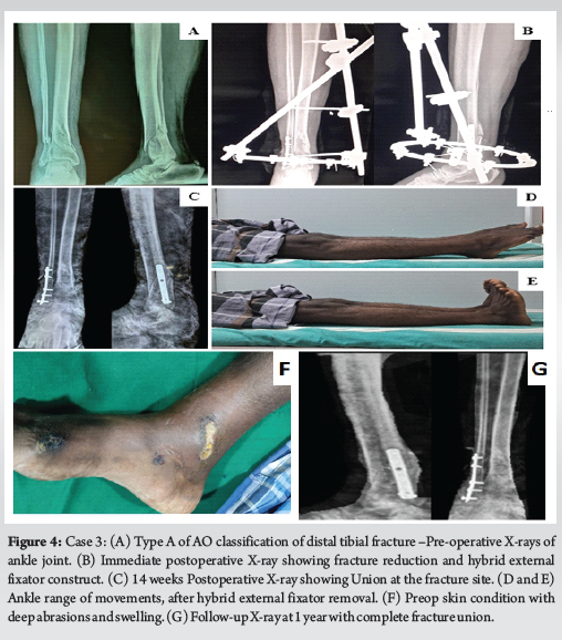 Hybrid External Fixation as A Comprehensive, Safe, and Effective ...