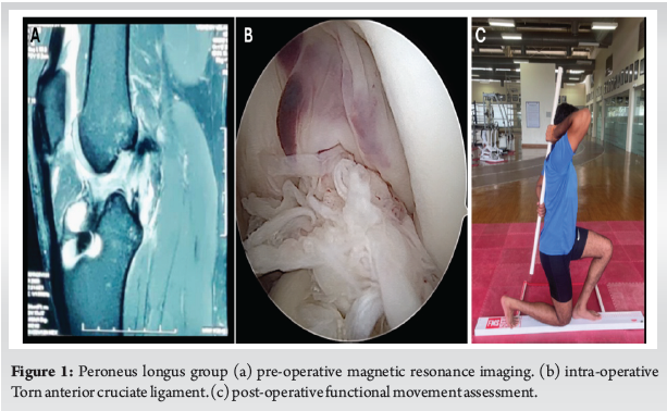 Ipsilateral Autologous Peroneus Longus and Bone Patellar Tendon Graft ...