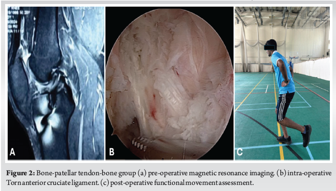 Ipsilateral Autologous Peroneus Longus and Bone Patellar Tendon Graft ...