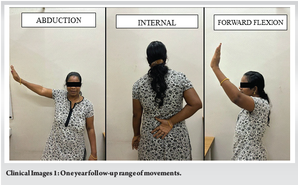 Functional Outcome of Hydrodilation in Adhesive Capsulitis of Shoulder ...