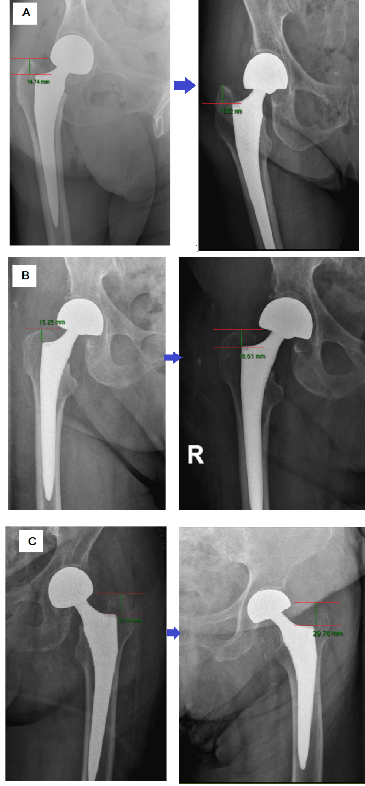 Femoral Stem Subsidence Rate with Cementless Stems in Patients with Sub ...