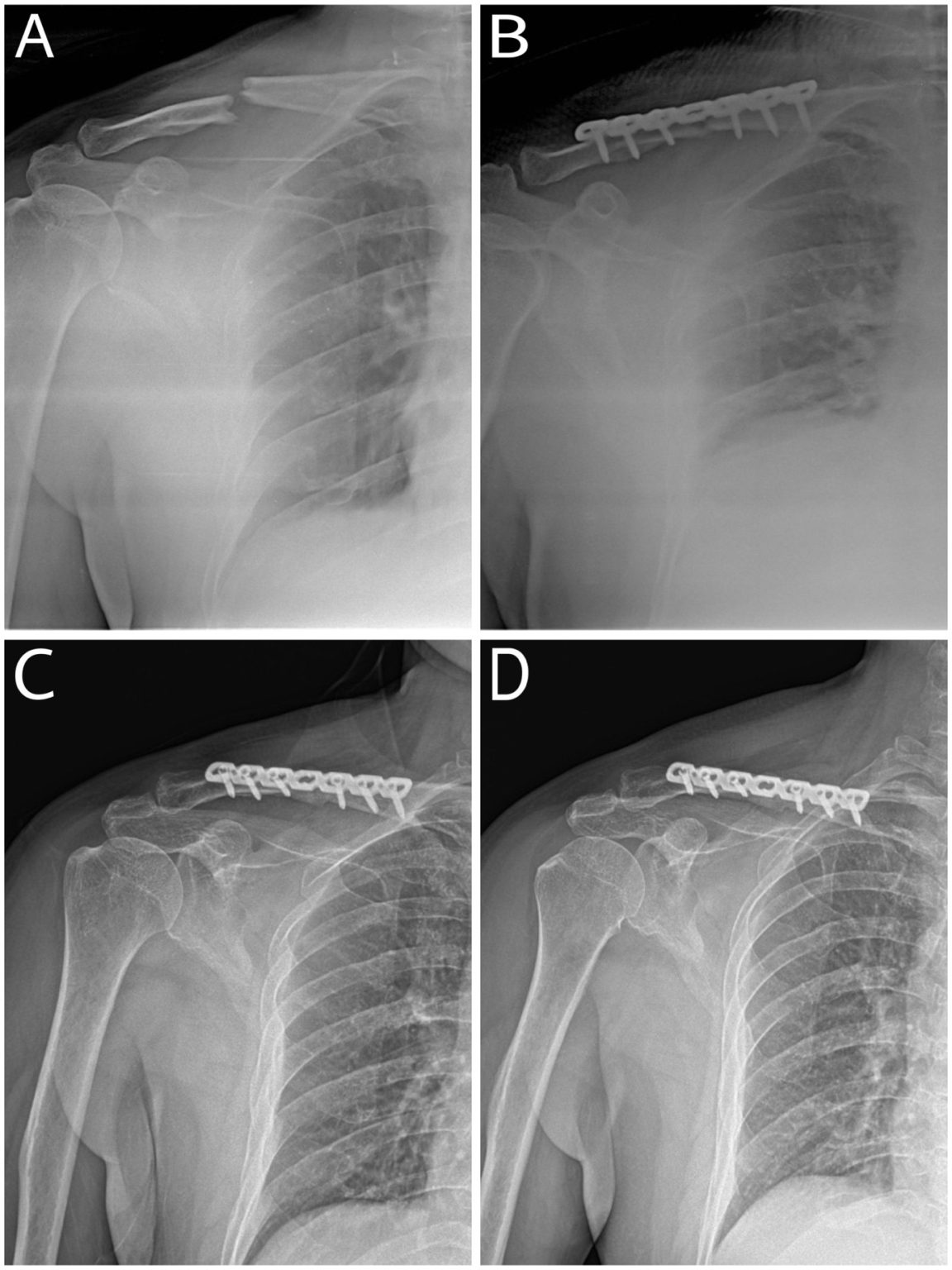 Functional and Radiological Outcomes of Anterior Clavicle Plating in ...